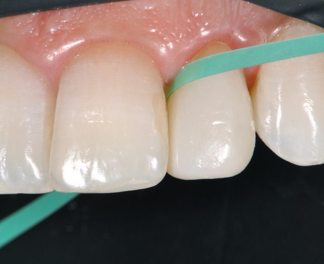 Discos Super Snap Rainbow Technique Kit Shofu – Denteeth