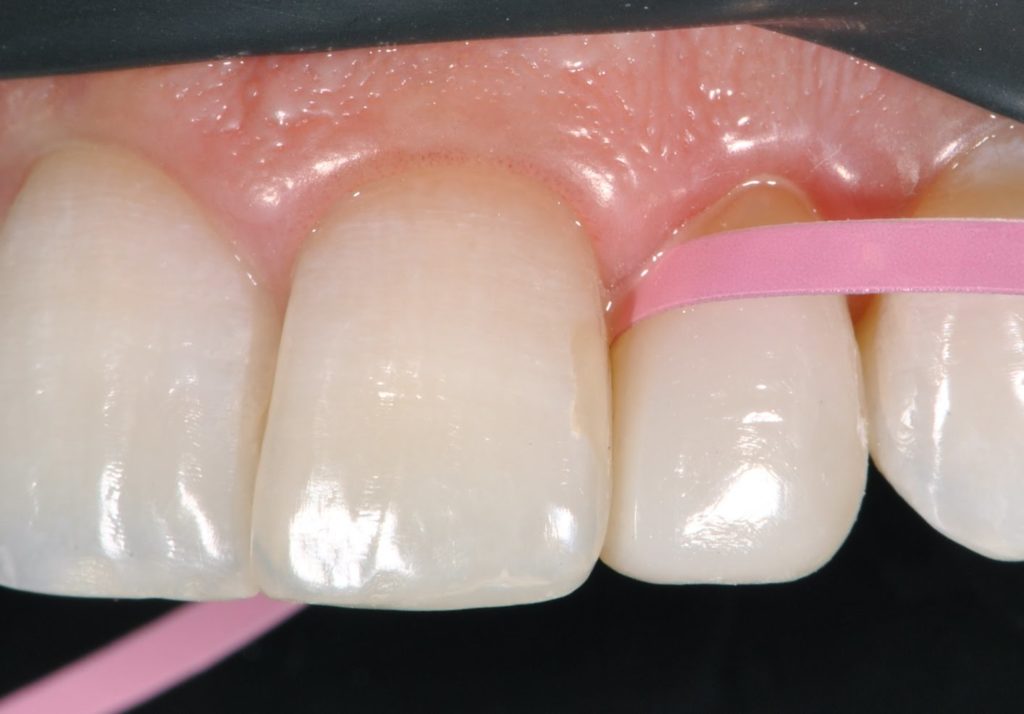 Discos Super Snap Rainbow Technique Kit Shofu – Denteeth