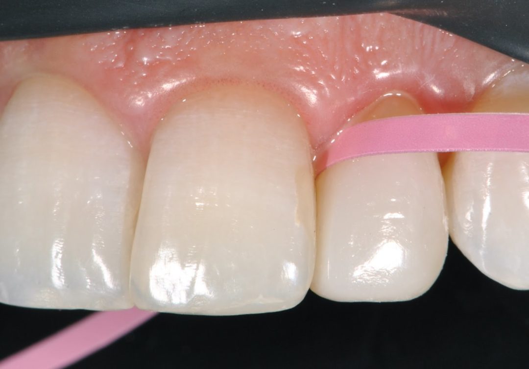 Discos Super Snap Rainbow Technique Kit Shofu – Denteeth