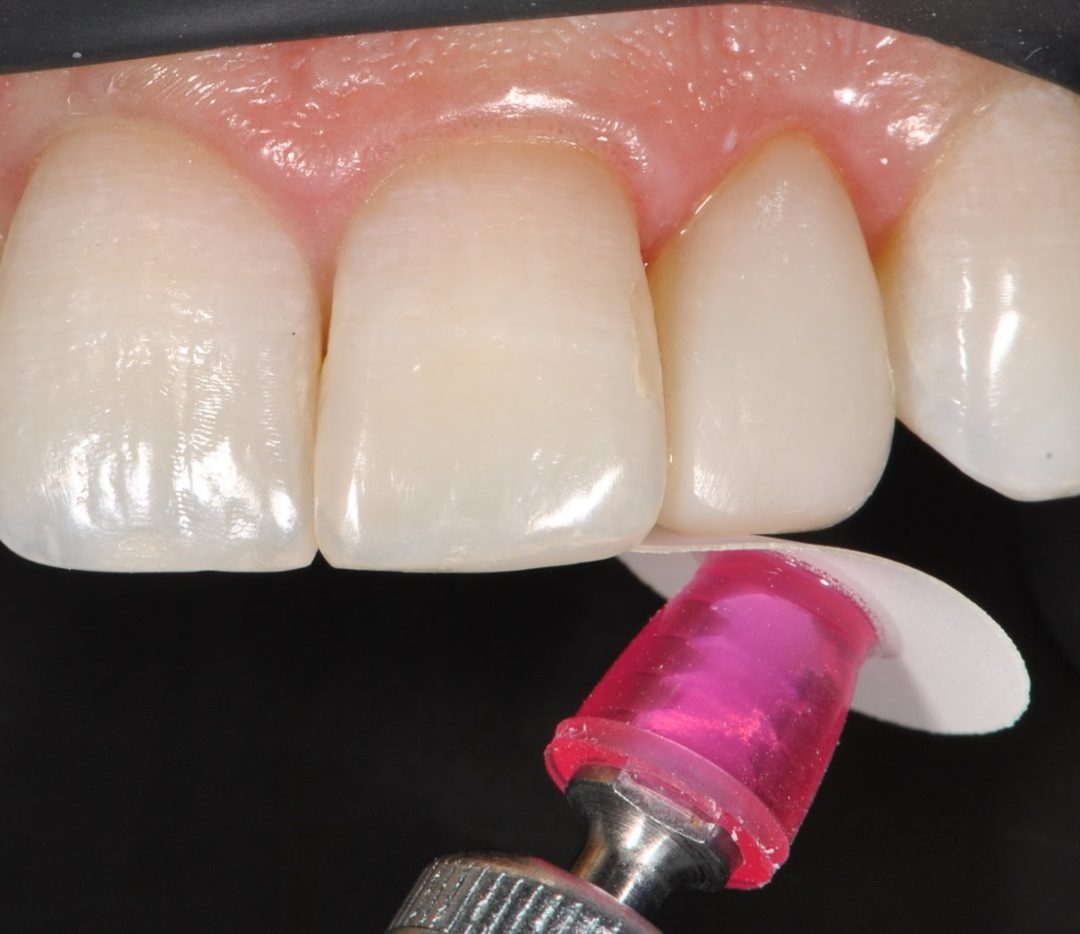 Discos Super Snap Shofu Mini Kit – Denteeth