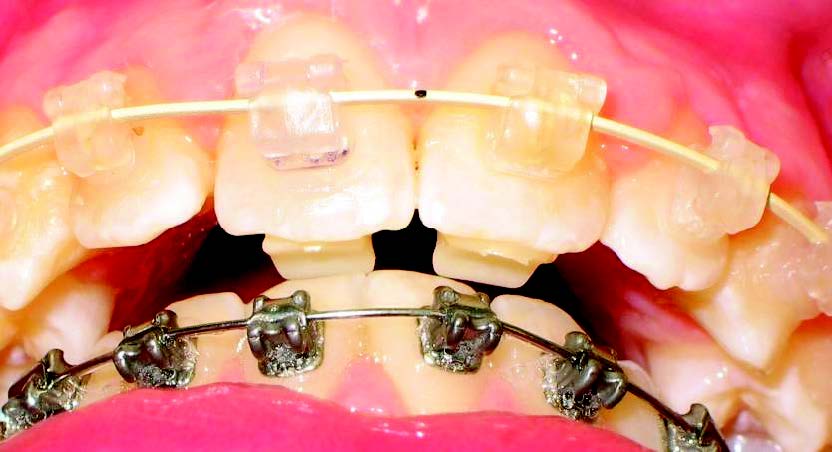 Denteeth | Mini Molds Kit Protect